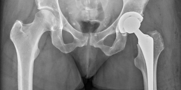 Hip Precautions After Hip Replacement Surgery | Hip Replacement ...