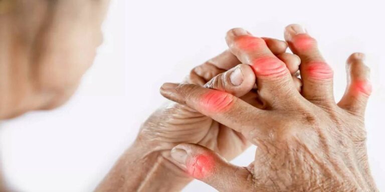 How To Prevent Arthritis? What Experts Say - Ortho Patna